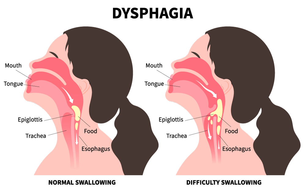 Dysphagia