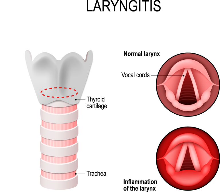 Common Causes Of Laryngitis 7232